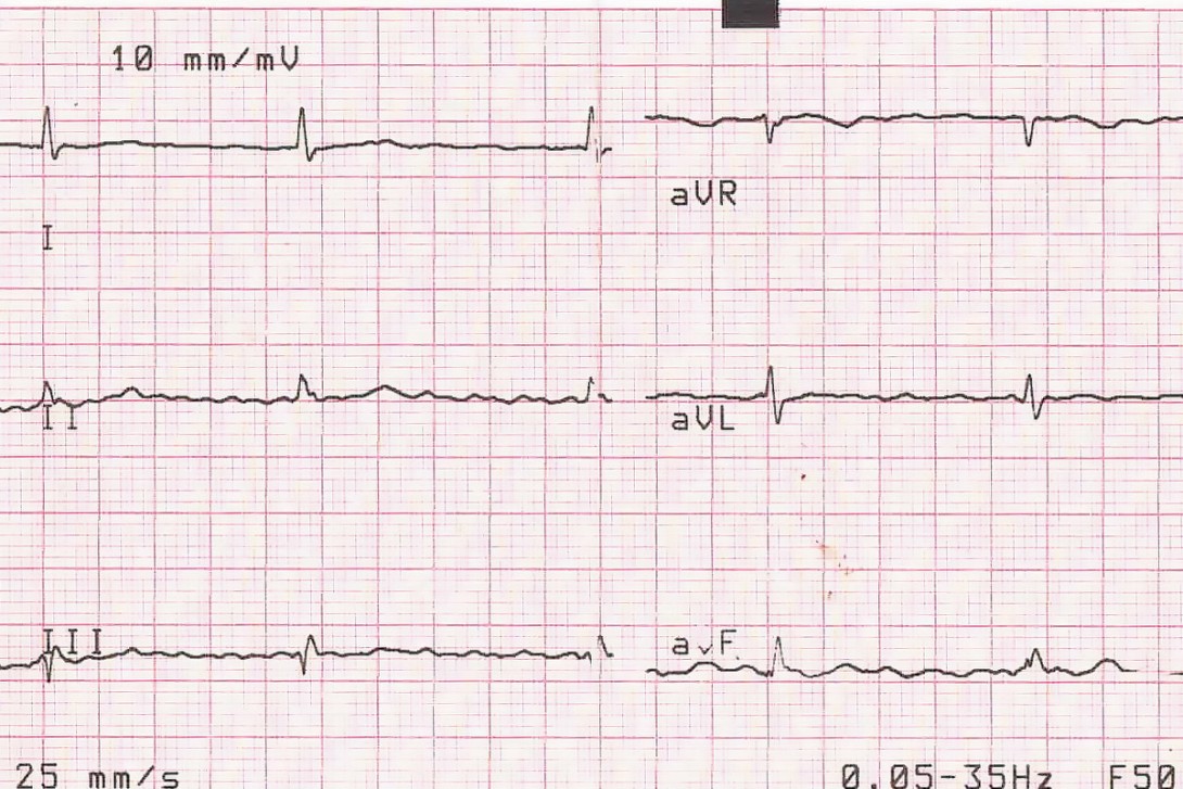 FitBit and an irregular pulse | Cardiology Today